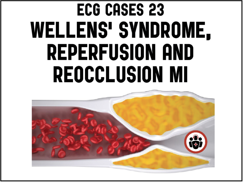 Wellens' syndrome, reperfusion and reocclusion MI | ECG Cases | EM Cases