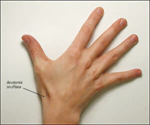 Palpate the snuffbox with the wrist in ulnar deviation to expose the ...