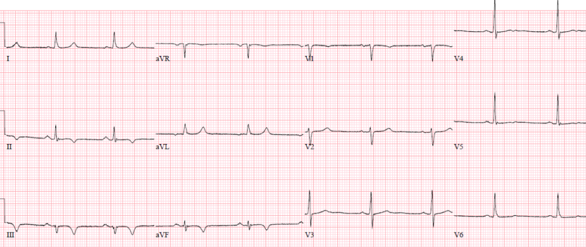 'Late STEMI' - How acute is the coronary occlusion? | ECG Cases | EM Cases