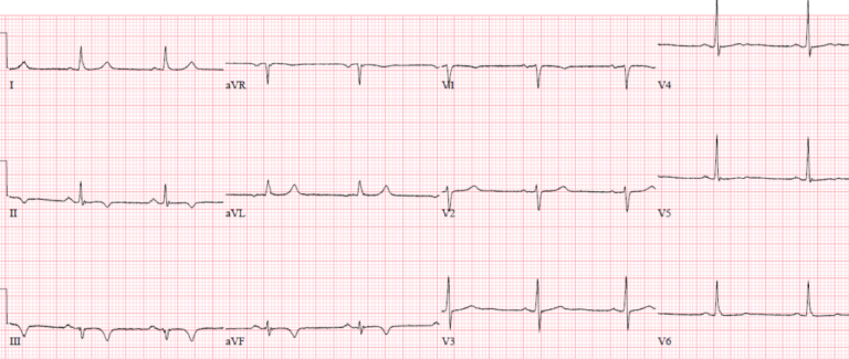 'Late STEMI' - How acute is the coronary occlusion? | ECG Cases | EM Cases