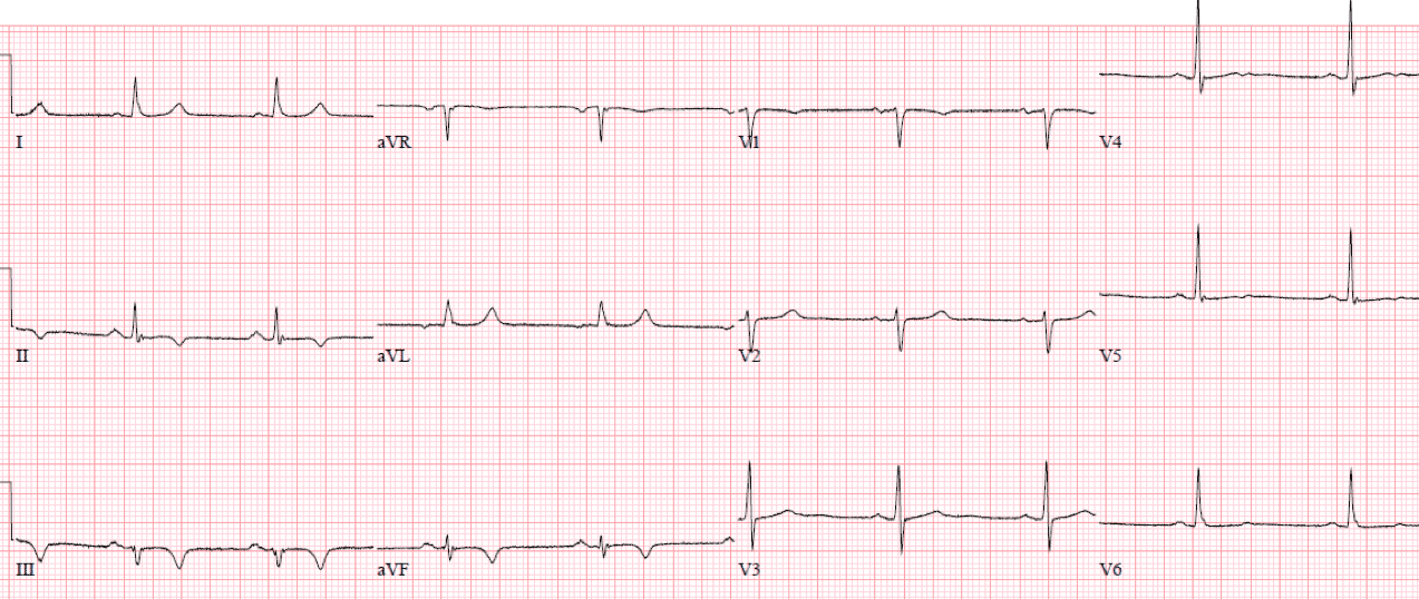 'Late STEMI' - How acute is the coronary occlusion? | ECG Cases | EM Cases
