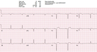 'Late STEMI' - How acute is the coronary occlusion? | ECG Cases | EM Cases