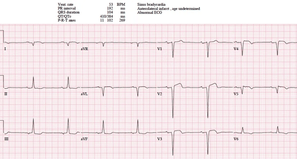 'Late STEMI' - How acute is the coronary occlusion? | ECG Cases | EM Cases