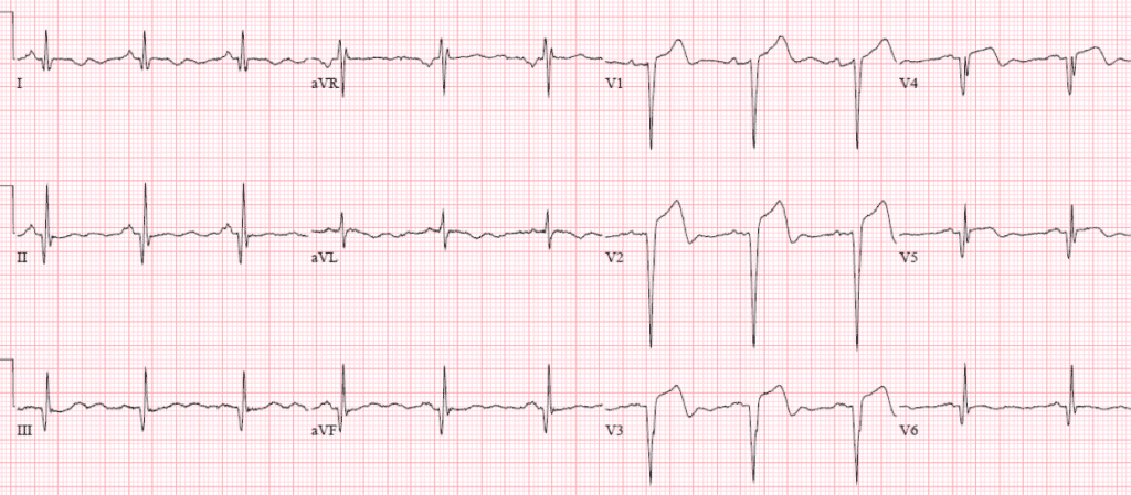 'Late STEMI' - How acute is the coronary occlusion? | ECG Cases | EM Cases