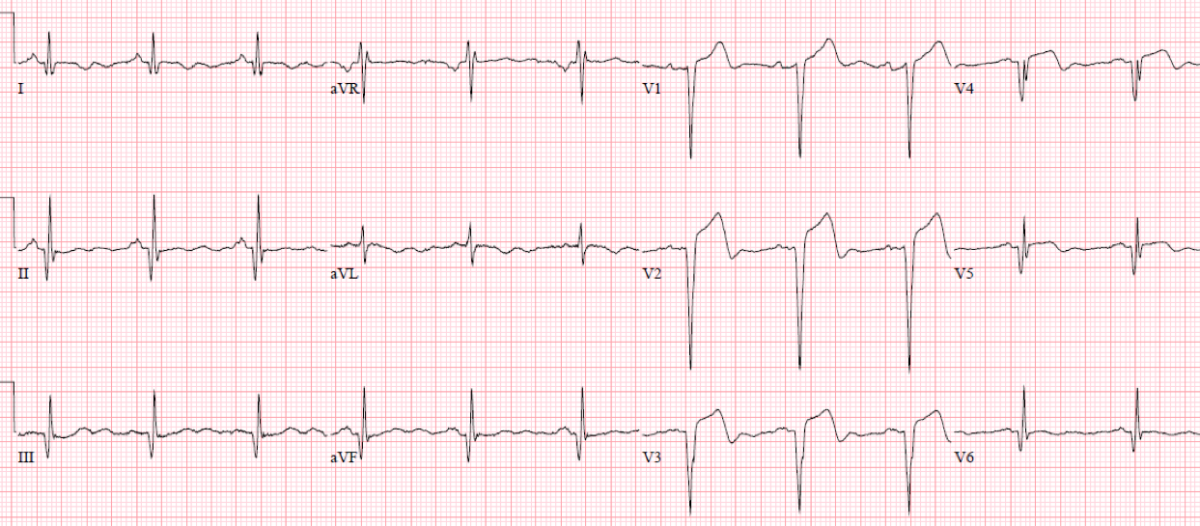 'Late STEMI' - How acute is the coronary occlusion? | ECG Cases | EM Cases