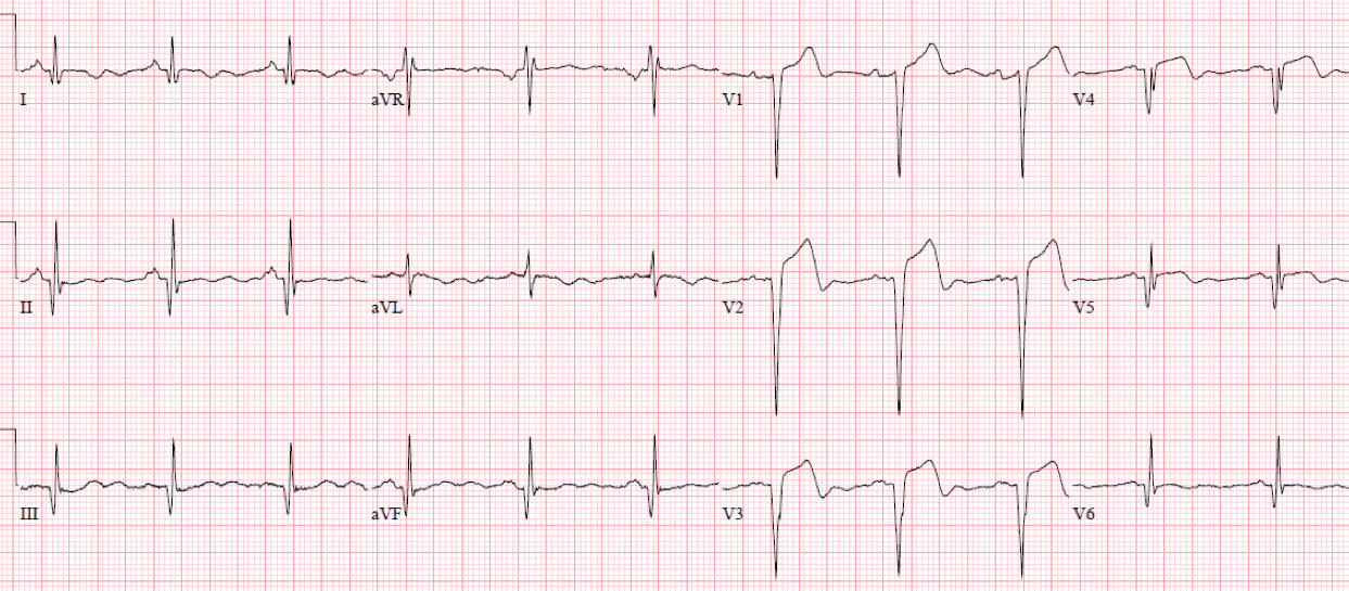 'Late STEMI' - How acute is the coronary occlusion? | ECG Cases | EM Cases