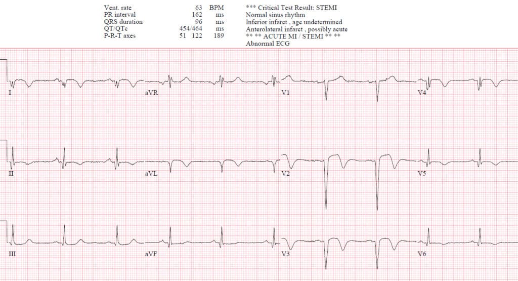 'Late STEMI' - How acute is the coronary occlusion? | ECG Cases | EM Cases
