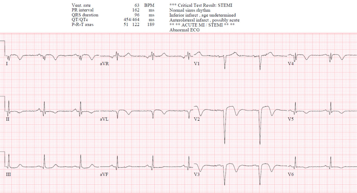 'Late STEMI' - How acute is the coronary occlusion? | ECG Cases | EM Cases
