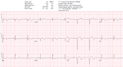 'Late STEMI' - How acute is the coronary occlusion? | ECG Cases | EM Cases