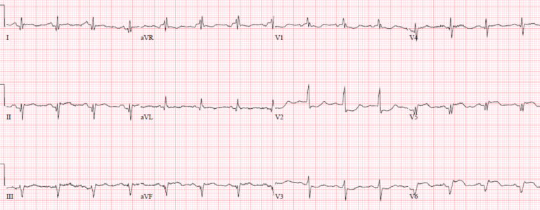 'Late STEMI' - How acute is the coronary occlusion? | ECG Cases | EM Cases