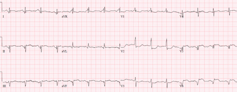 'Late STEMI' - How acute is the coronary occlusion? | ECG Cases | EM Cases