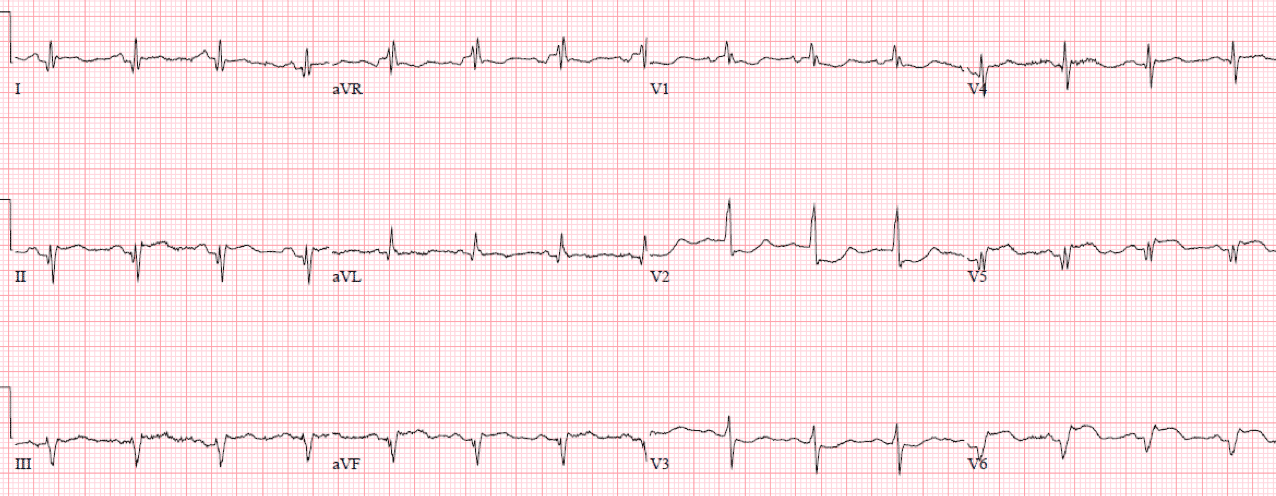 'Late STEMI' - How acute is the coronary occlusion? | ECG Cases | EM Cases