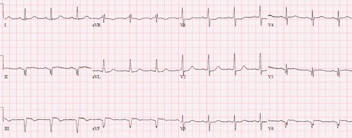 'Late STEMI' - How acute is the coronary occlusion? | ECG Cases | EM Cases