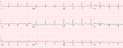 'Late STEMI' - How acute is the coronary occlusion? | ECG Cases | EM Cases