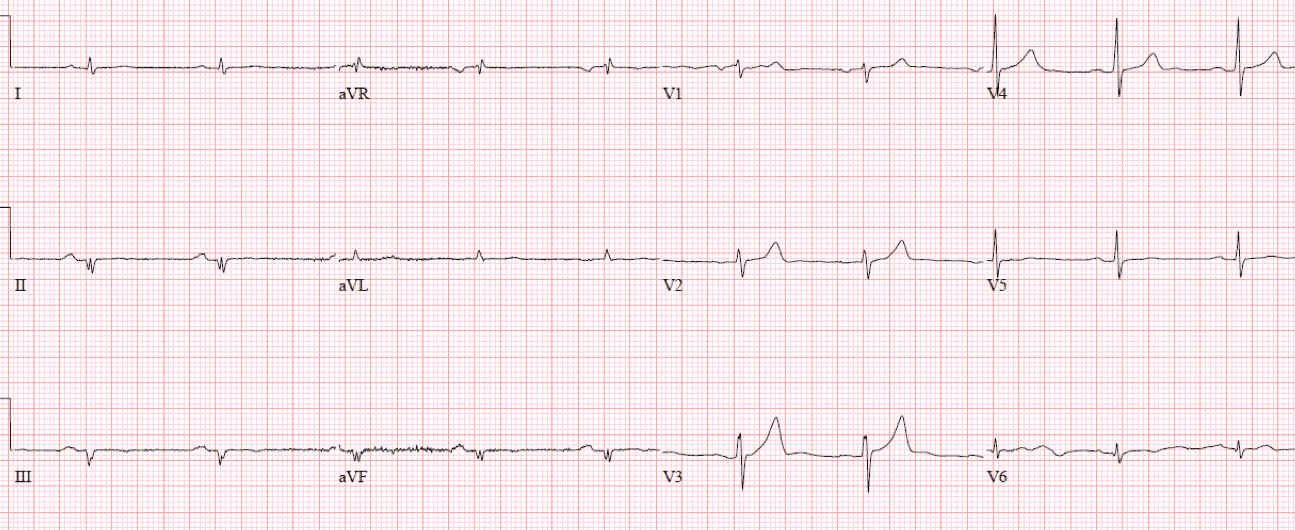 'Late STEMI' - How acute is the coronary occlusion? | ECG Cases | EM Cases