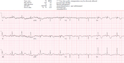 'Late STEMI' - How acute is the coronary occlusion? | ECG Cases | EM Cases