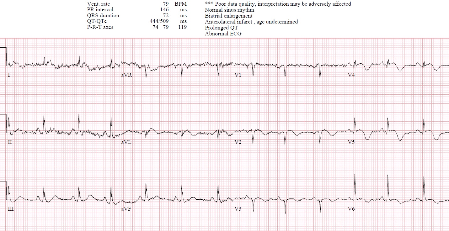 'Late STEMI' - How acute is the coronary occlusion? | ECG Cases | EM Cases