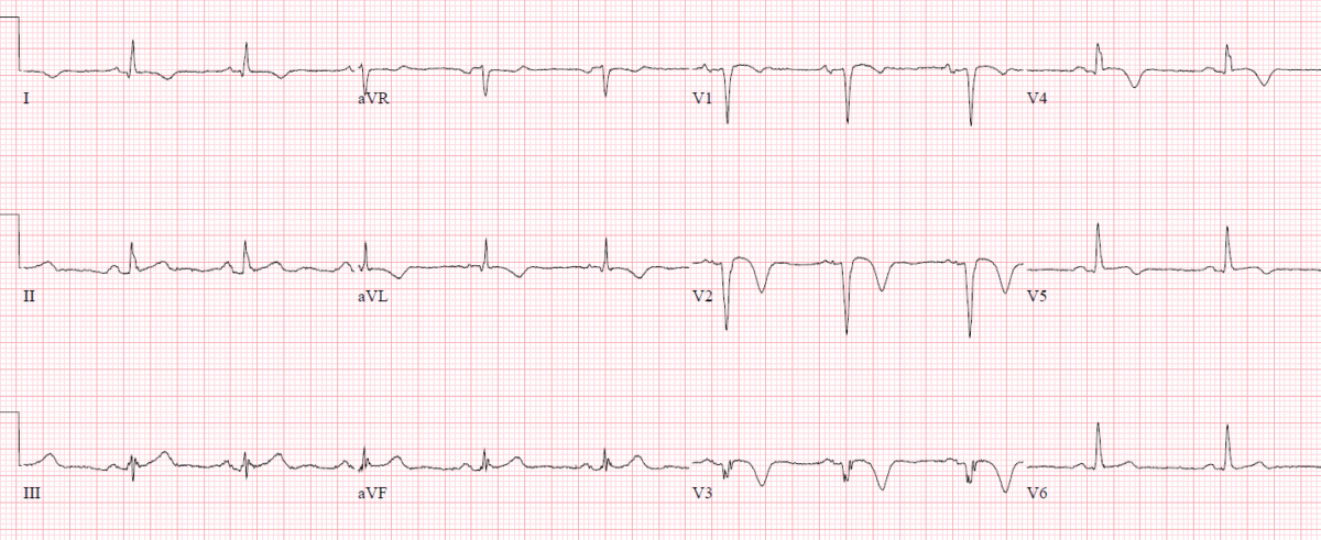 'Late STEMI' - How acute is the coronary occlusion? | ECG Cases | EM Cases