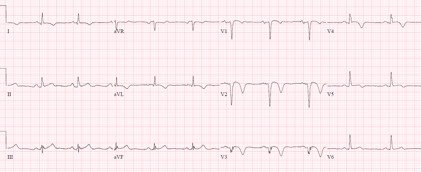 'Late STEMI' - How acute is the coronary occlusion? | ECG Cases | EM Cases