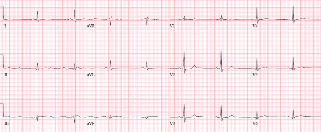 'Late STEMI' - How acute is the coronary occlusion? | ECG Cases | EM Cases