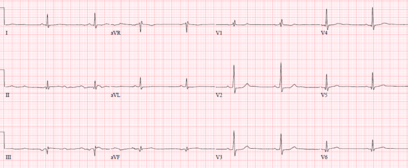 'Late STEMI' - How acute is the coronary occlusion? | ECG Cases | EM Cases