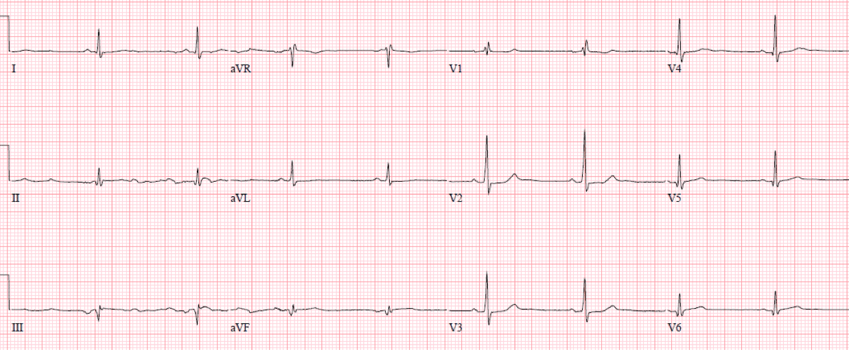 'Late STEMI' - How acute is the coronary occlusion? | ECG Cases | EM Cases