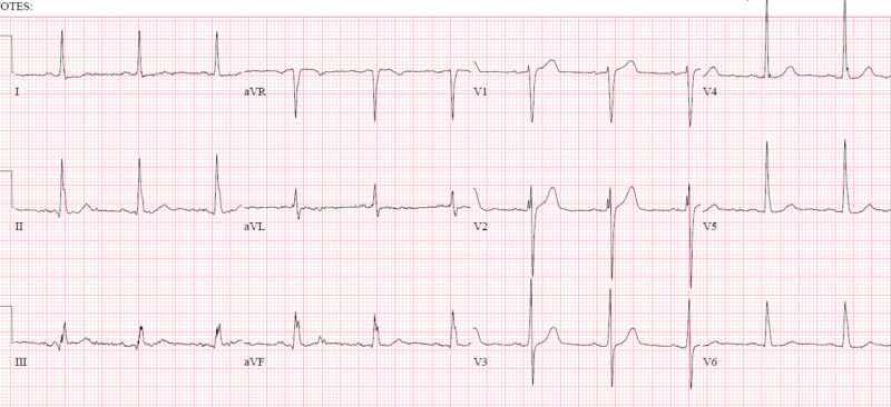 Reciprocal Changes and Occlusion MI | ECG Cases | Emergency Medicine Cases