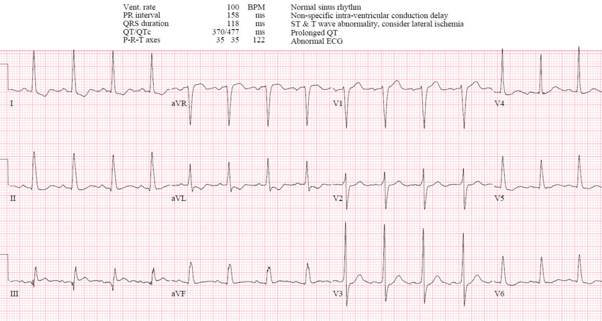 Reciprocal Changes and Occlusion MI | ECG Cases | Emergency Medicine Cases