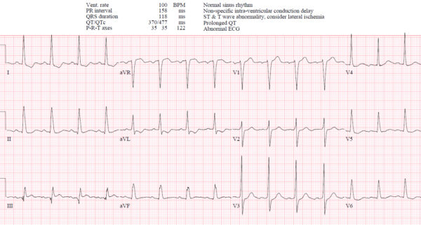Reciprocal Changes and Occlusion MI | ECG Cases | Emergency Medicine Cases