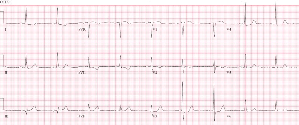 Reciprocal Changes and Occlusion MI | ECG Cases | Emergency Medicine Cases