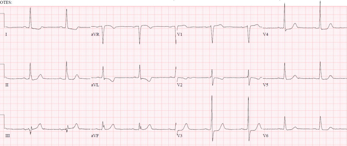 Reciprocal Changes and Occlusion MI | ECG Cases | Emergency Medicine Cases