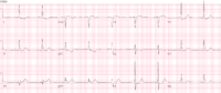 Reciprocal Changes and Occlusion MI | ECG Cases | Emergency Medicine Cases