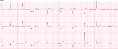 Reciprocal Changes and Occlusion MI | ECG Cases | Emergency Medicine Cases