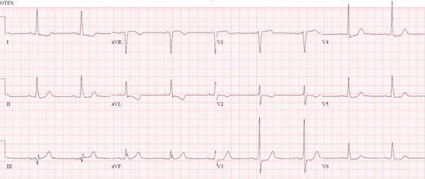 Reciprocal Changes and Occlusion MI | ECG Cases | Emergency Medicine Cases