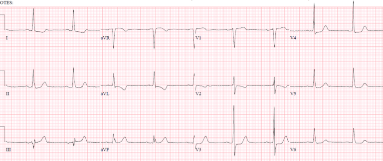 Reciprocal Changes and Occlusion MI | ECG Cases | Emergency Medicine Cases