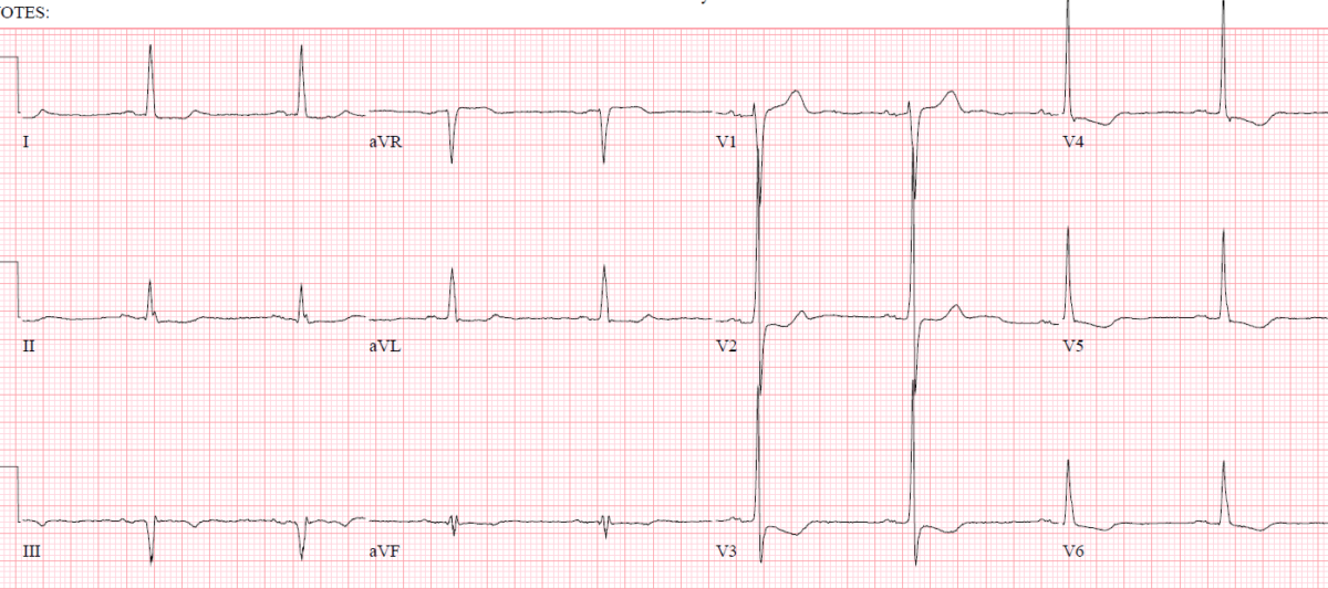 Reciprocal Changes and Occlusion MI | ECG Cases | Emergency Medicine Cases