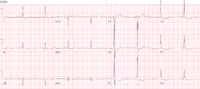 Reciprocal Changes and Occlusion MI | ECG Cases | Emergency Medicine Cases