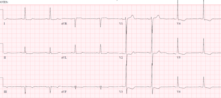 Reciprocal Changes and Occlusion MI | ECG Cases | Emergency Medicine Cases