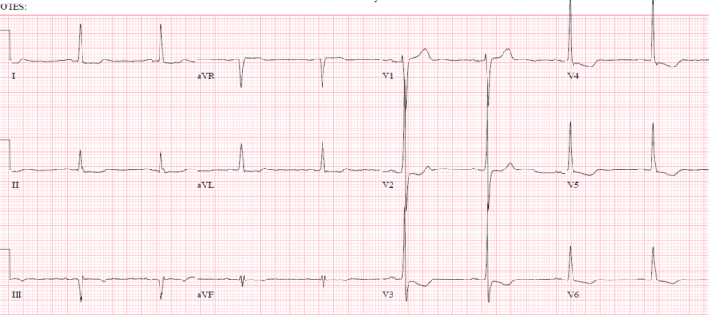 Reciprocal Changes and Occlusion MI | ECG Cases | Emergency Medicine Cases