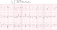 Reciprocal Changes and Occlusion MI | ECG Cases | Emergency Medicine Cases