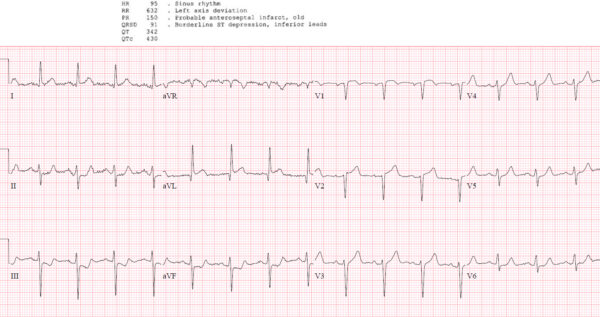 Reciprocal Changes and Occlusion MI | ECG Cases | Emergency Medicine Cases
