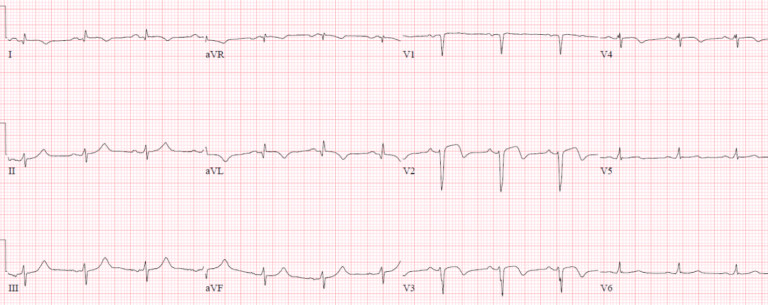 Reciprocal Changes and Occlusion MI | ECG Cases | Emergency Medicine Cases