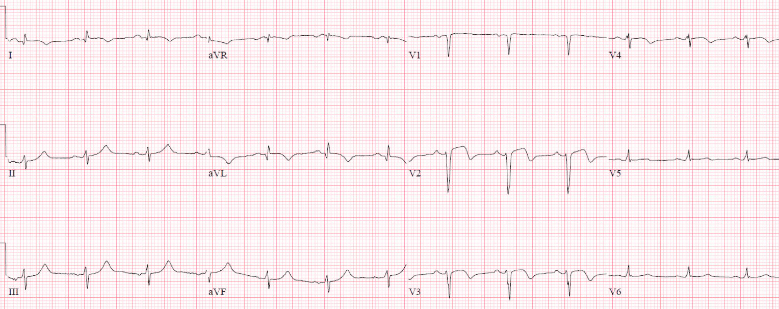 Reciprocal Changes and Occlusion MI | ECG Cases | Emergency Medicine Cases
