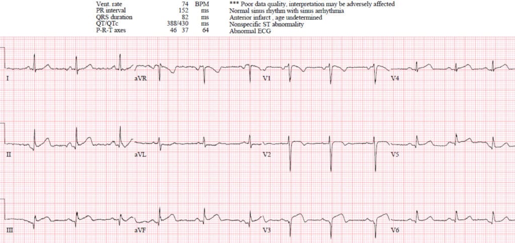 Reciprocal Changes and Occlusion MI | ECG Cases | Emergency Medicine Cases