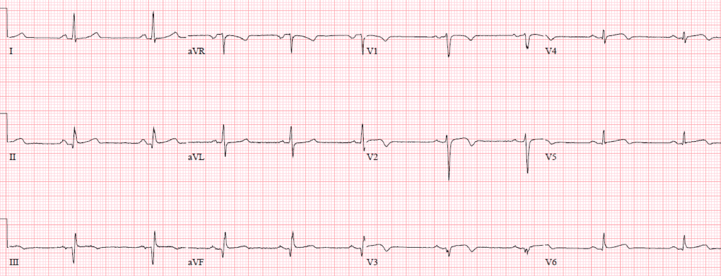 Reciprocal Changes and Occlusion MI | ECG Cases | Emergency Medicine Cases
