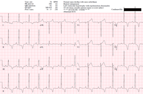Reciprocal Changes and Occlusion MI | ECG Cases | Emergency Medicine Cases