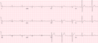 Reciprocal Changes and Occlusion MI | ECG Cases | Emergency Medicine Cases