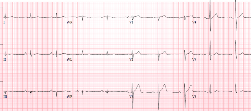 Reciprocal Changes and Occlusion MI | ECG Cases | Emergency Medicine Cases