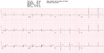 Reciprocal Changes and Occlusion MI | ECG Cases | Emergency Medicine Cases