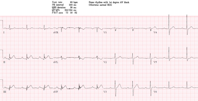 Reciprocal Changes and Occlusion MI | ECG Cases | Emergency Medicine Cases